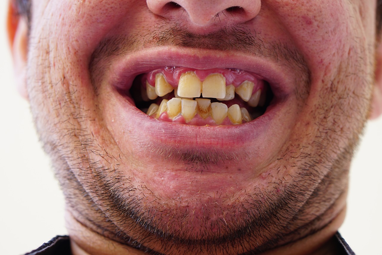 I Have Really Bad Teeth. What Are My Options? - Express Dentist