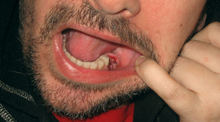 Wisdom Teeth FAQ - Express Dentist